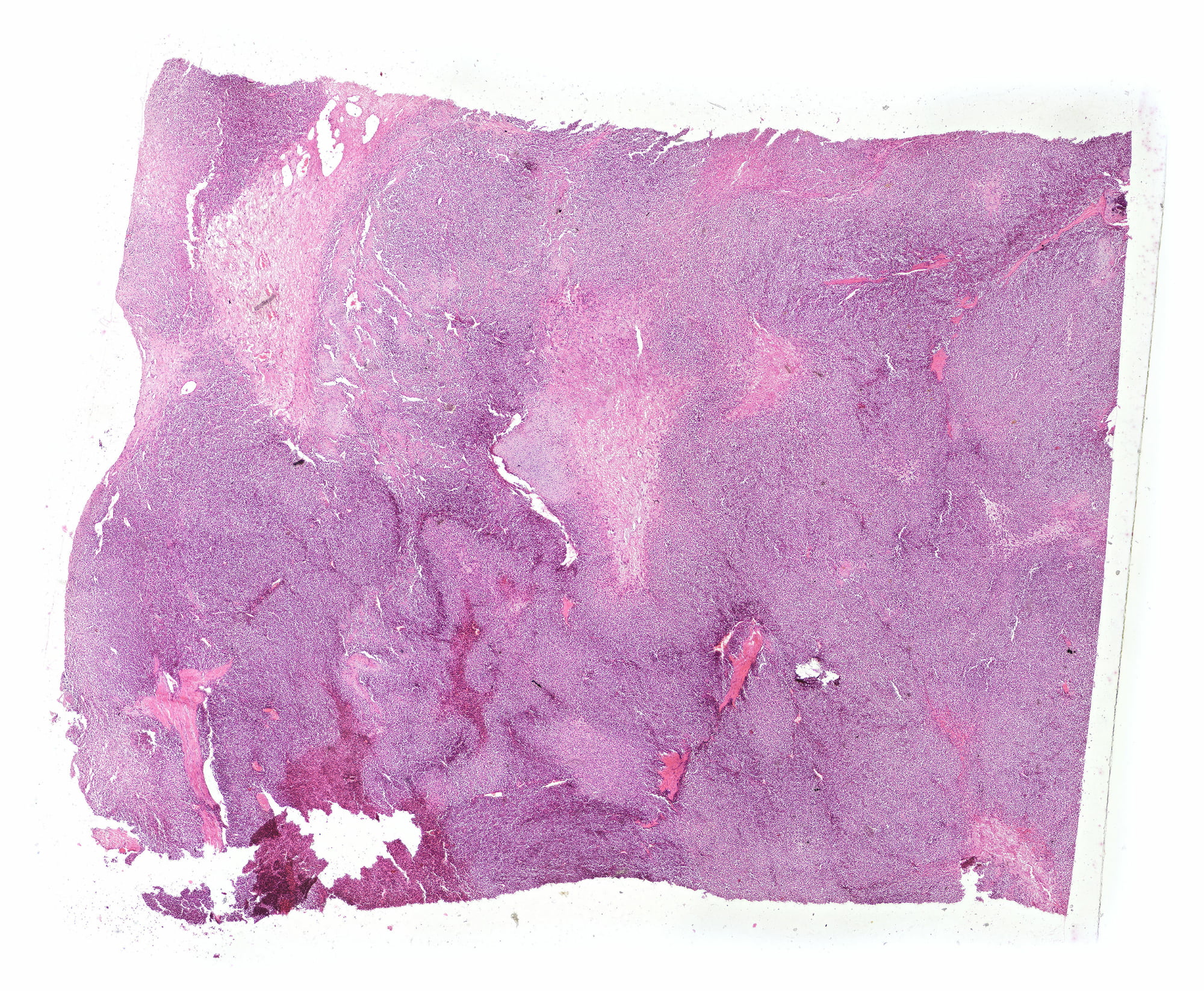Sarcoma of the Thigh