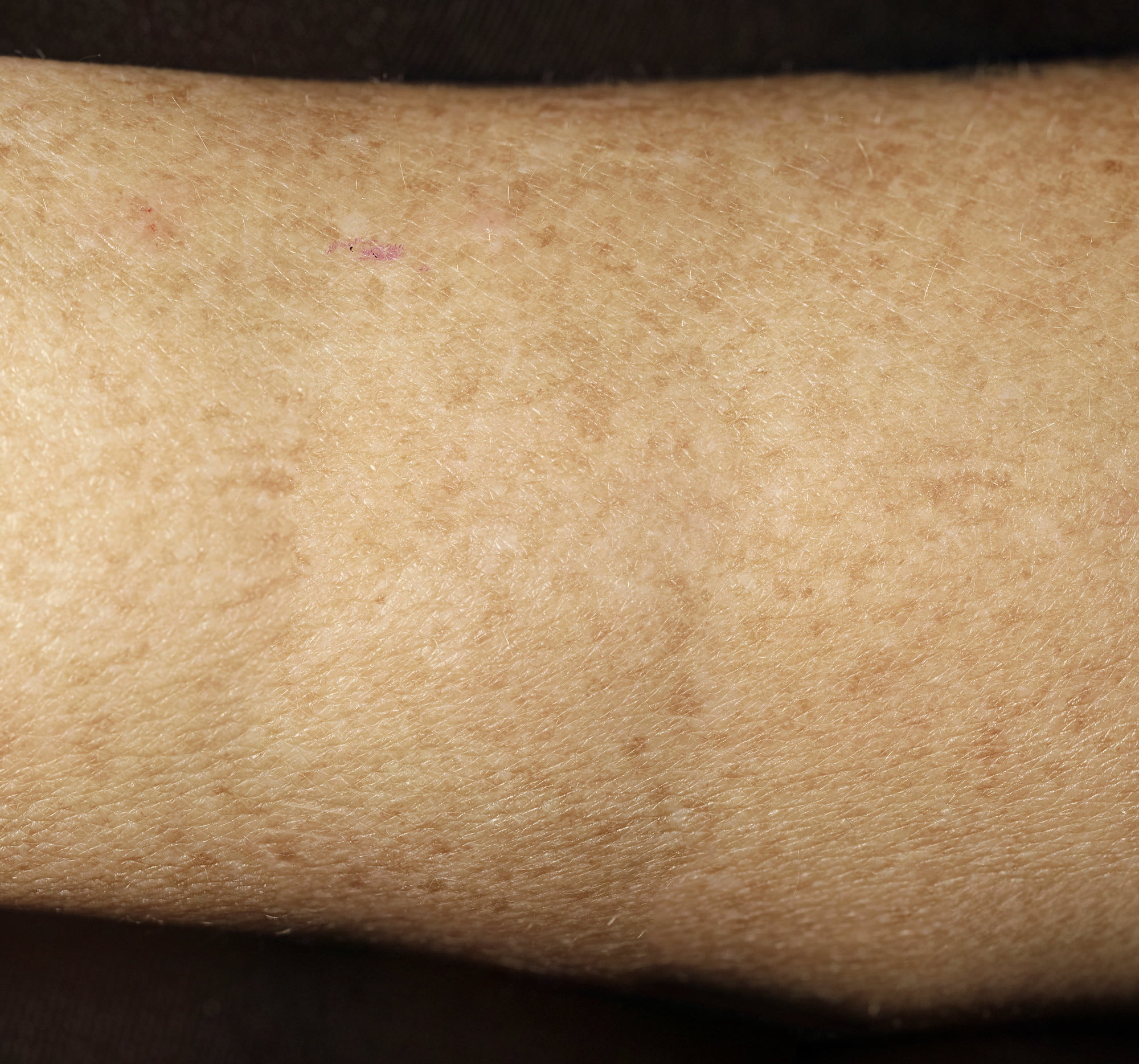 Skin Imaging Example 2