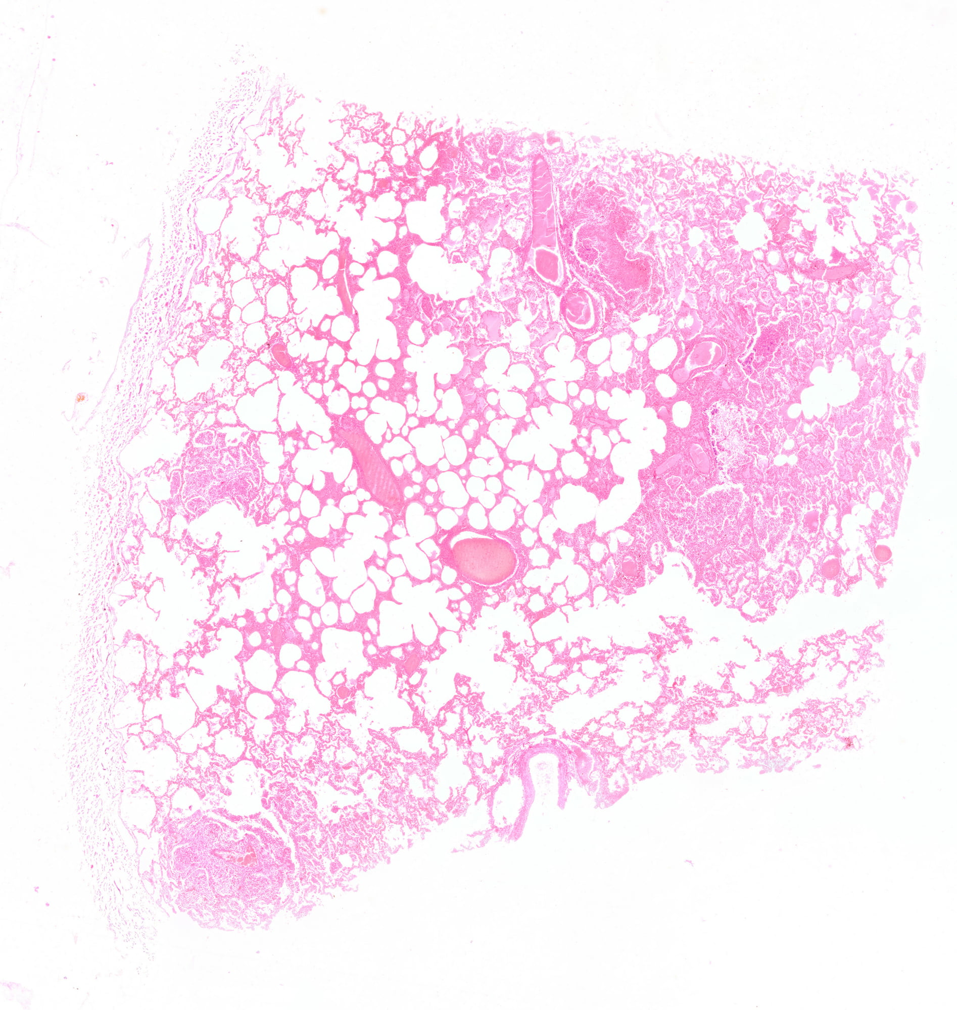 Tuberculosis Sample Slide